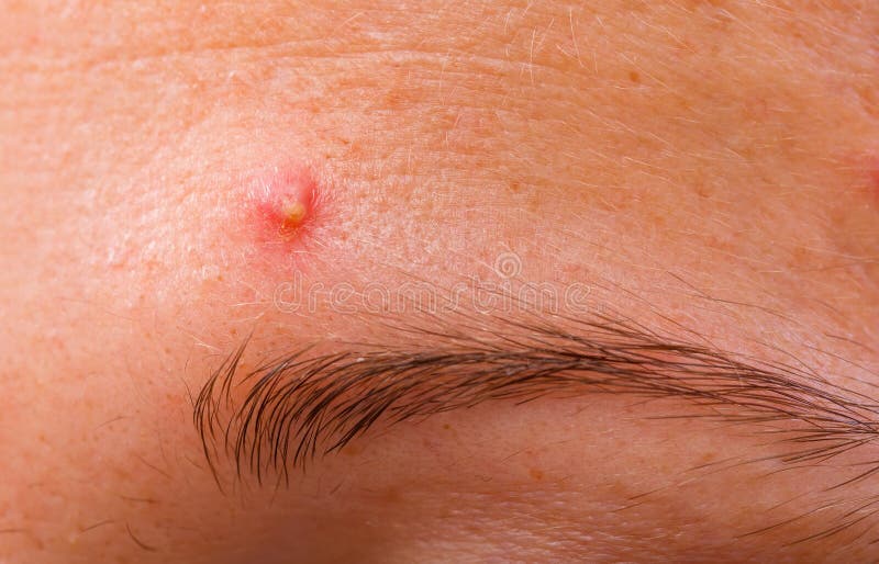 Aknehaut stockbild. Bild von blasen, schmerzlich, dermatologie - 37752423