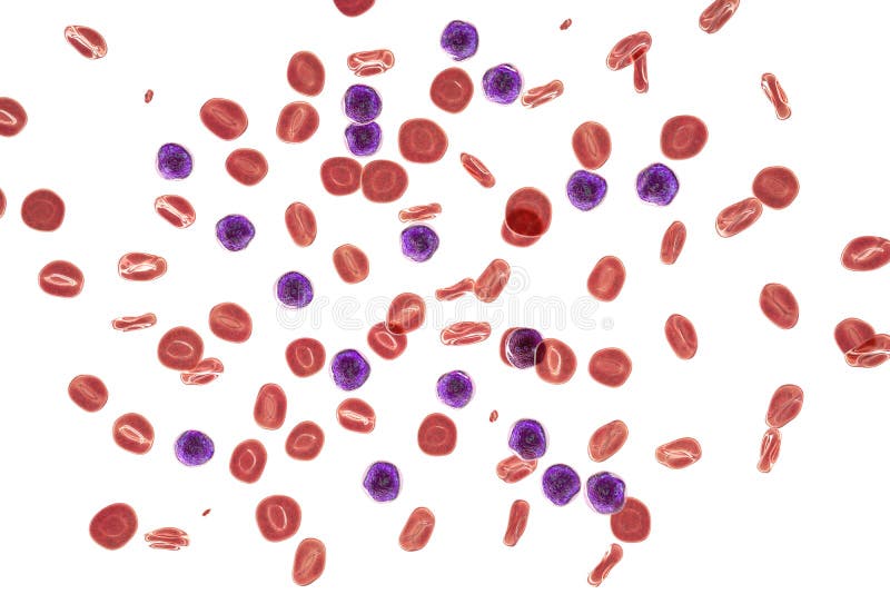 Leukemiceller i blodsudd fotografering för bildbyråer. Bild av cell ...