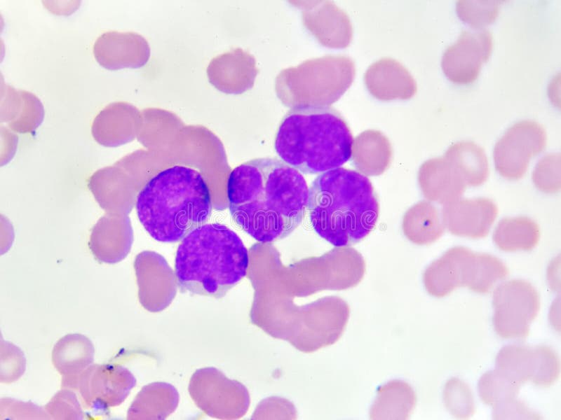 Akut myeloid leukemi AML arkivfoto. Bild av kontroll - 99238624