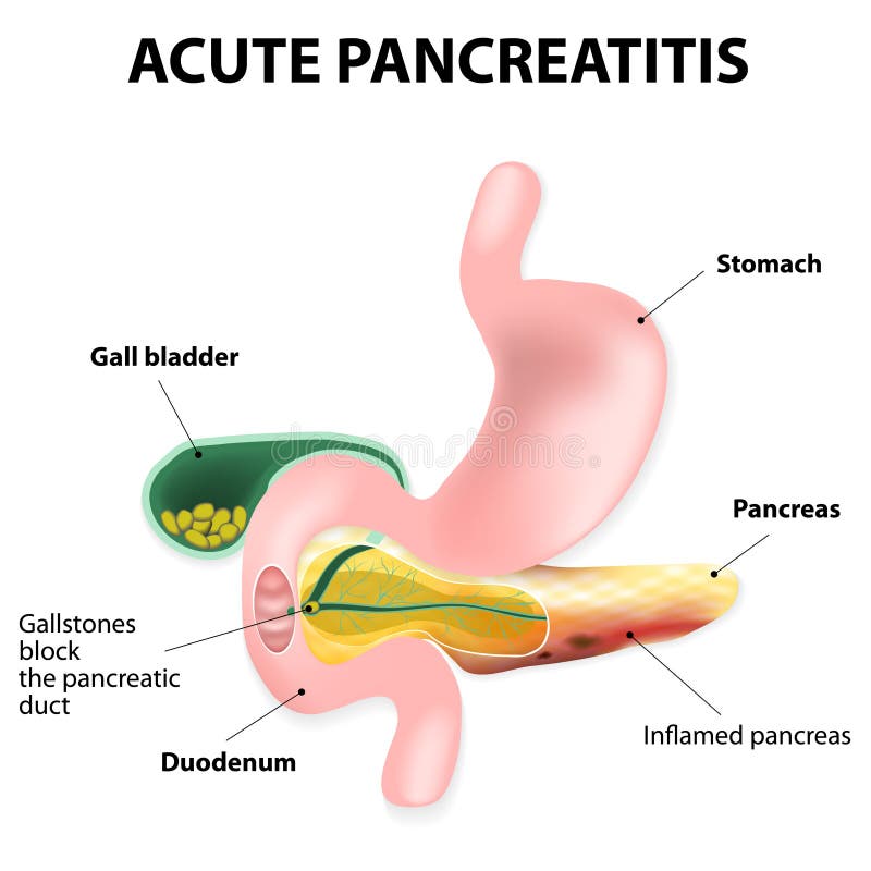 Akut Pancreatitis vektor illustrationer. Illustration av förstoppad ...