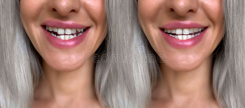 Alignment and Correction of Tooth Defects Stock Image - Image of open ...