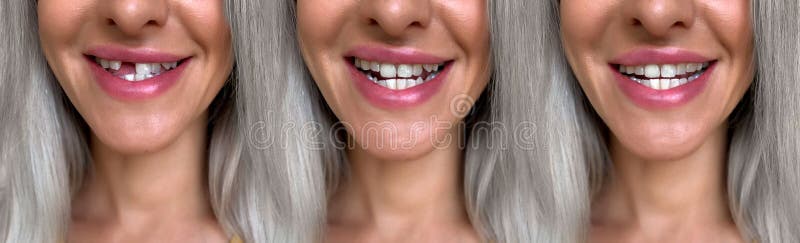 Alignment and Correction of Tooth Defects Stock Photo - Image of girl ...