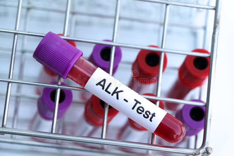 ALK Test To Look for Abnormalities from Blood Stock Photo - Image of ...