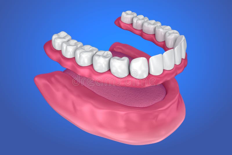 All Missing Teeth - Removable Full Denture. Stock Illustration ...