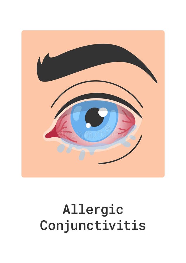 Allergic Conjunctivitis Eye Disease Stock Vector - Illustration of ...