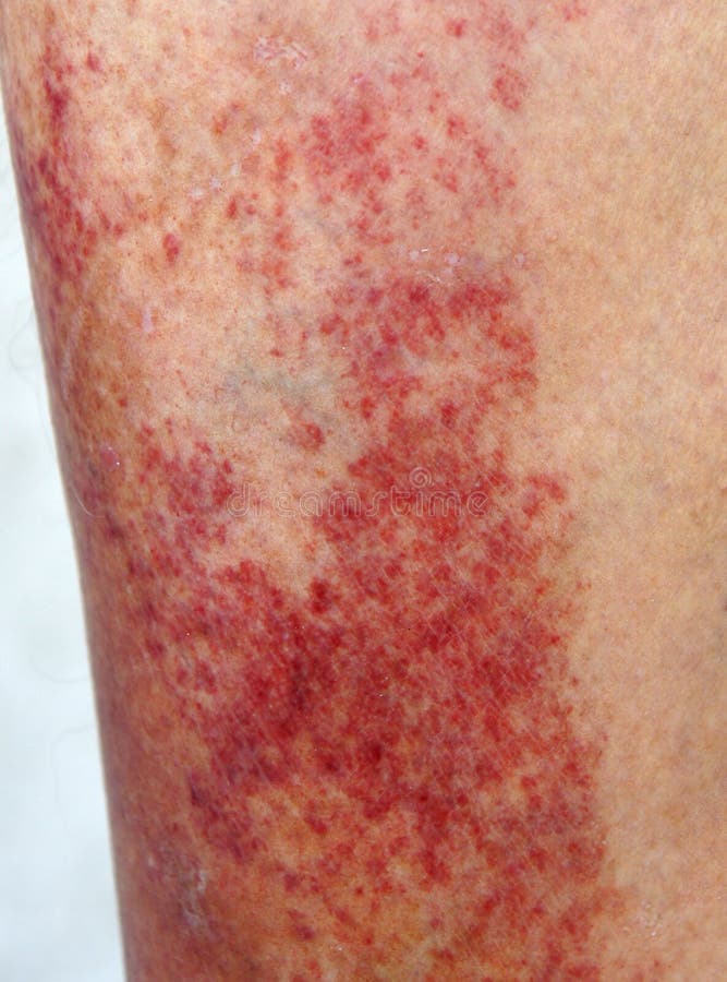 Contact Dermatitis Legs