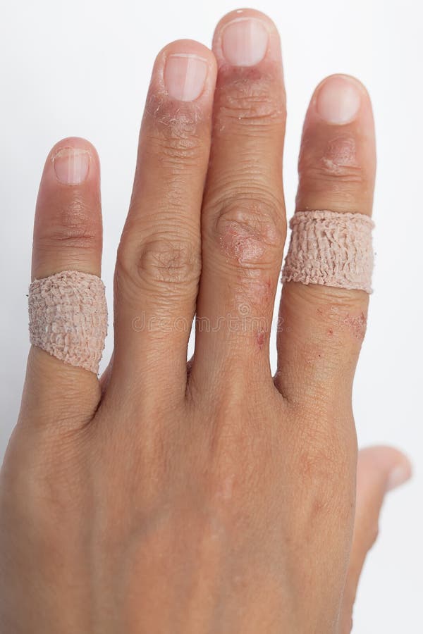 Allergic Lesions in the Plaster Women. Stock Image - Image of plaster ...