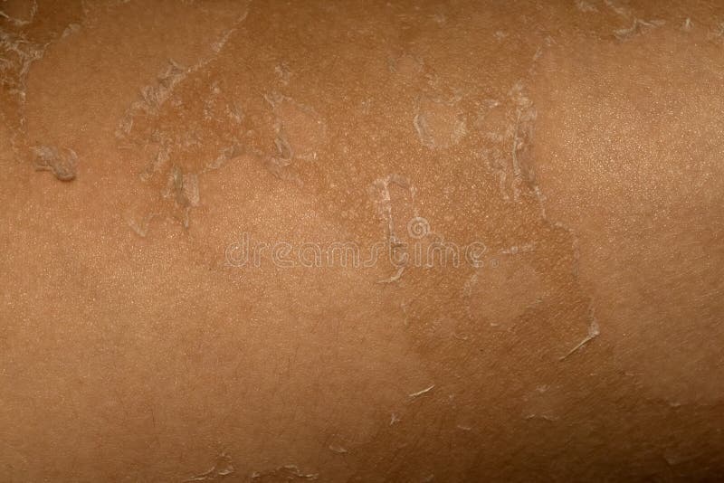 Manifestations of an Allergic Reaction To the Sun. Photodermatitis ...