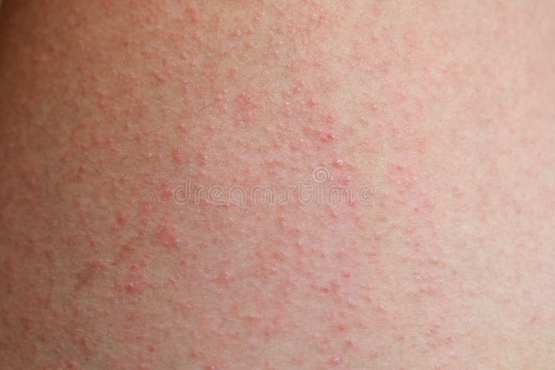 Allergic Rash Dermatitis Skin Stock Image - Image of people, pain: 53330035