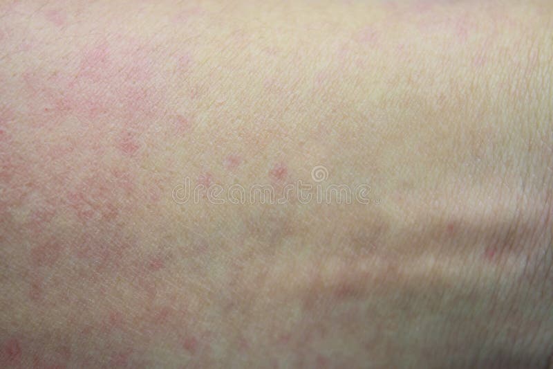 Ill Allergic Rash Dermatitis Eczema Skin of Patient Stock Photo - Image ...