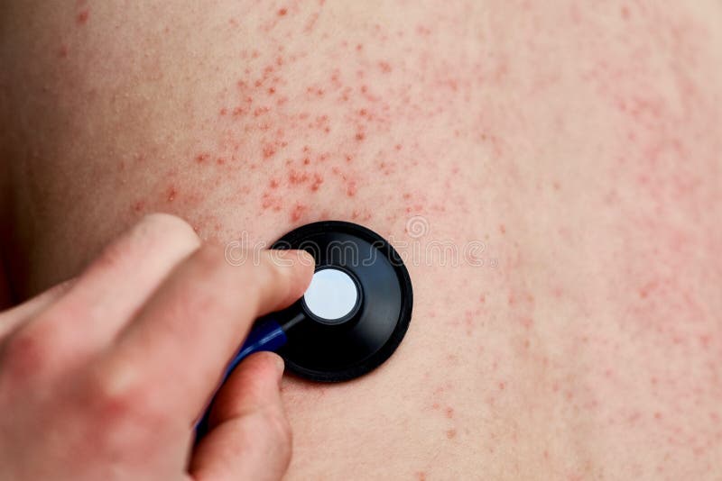 Allergic Rash on Skin. Woman with Dermatology Problem on Back Skin ...