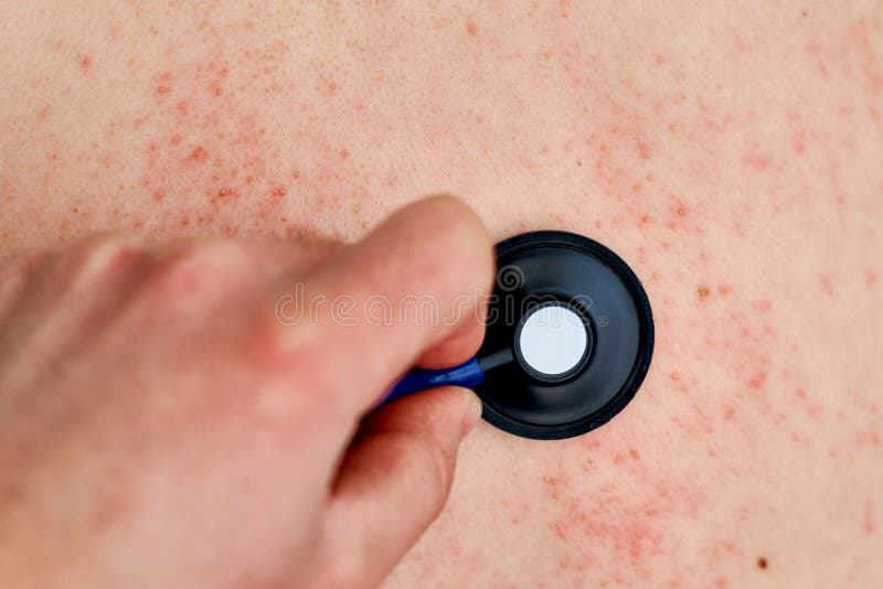 Allergic Rash on Skin. Woman with Dermatology Problem on Back Skin ...