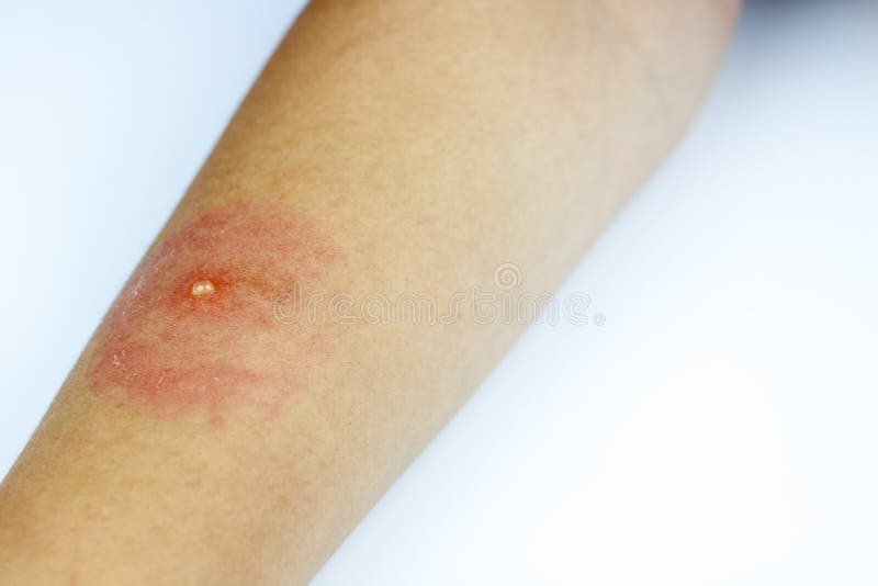 Allergic Reactions To Insect Stings Stock Photo - Image of body ...