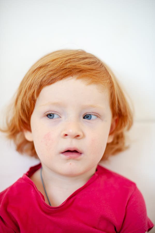 Allergies, Dermatite Atopique Sur Le Visage Photo stock - Image du ...