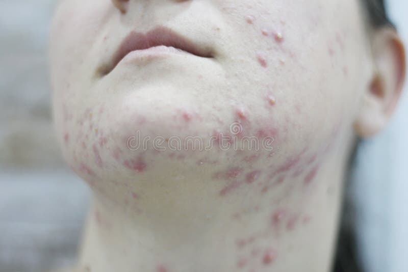 Allergy Concept,young Girl with Problematic Pimple on the Face.-image ...