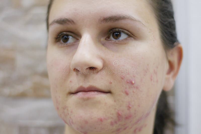 Allergy Concept,young Girl with Problematic Pimple on the Face.-image ...
