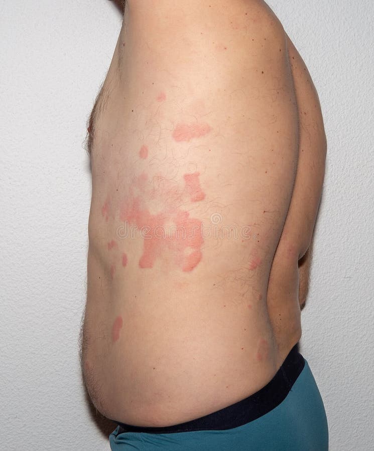 Allergy. Health. Reaction. Histamine. Intolerance Stock Image - Image ...