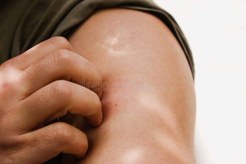 Allergy Mark and Redness, Itching on a Man S Arm. Allergic Reaction To ...