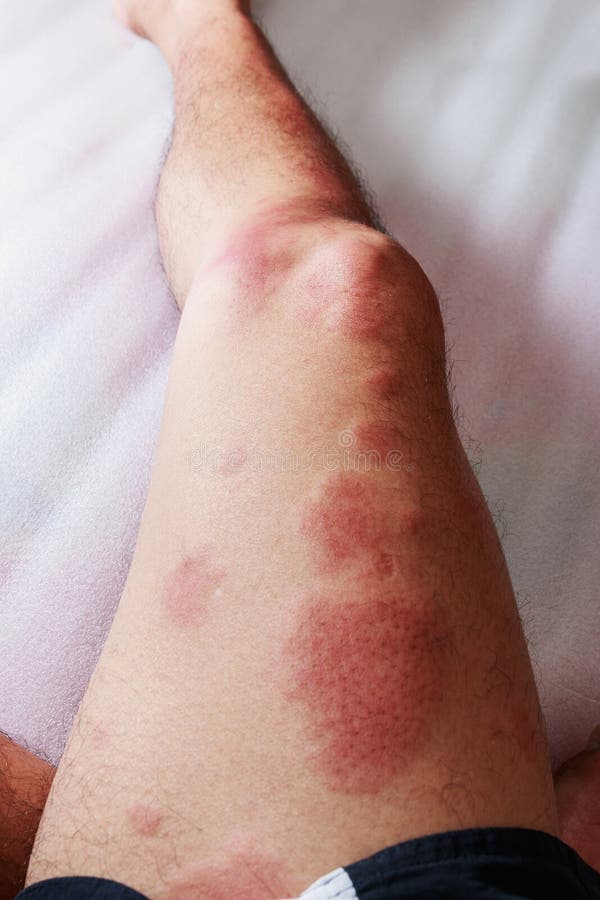 Around Legs Allergy Rash and Health Problem. Stock Photo - Image of ...