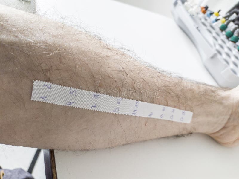 Allergy scratch test stock photo. Image of human, experiment - 176430278