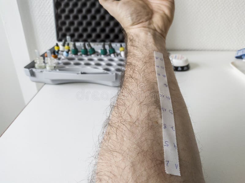 Allergy scratch test stock photo. Image of allergen - 176672616