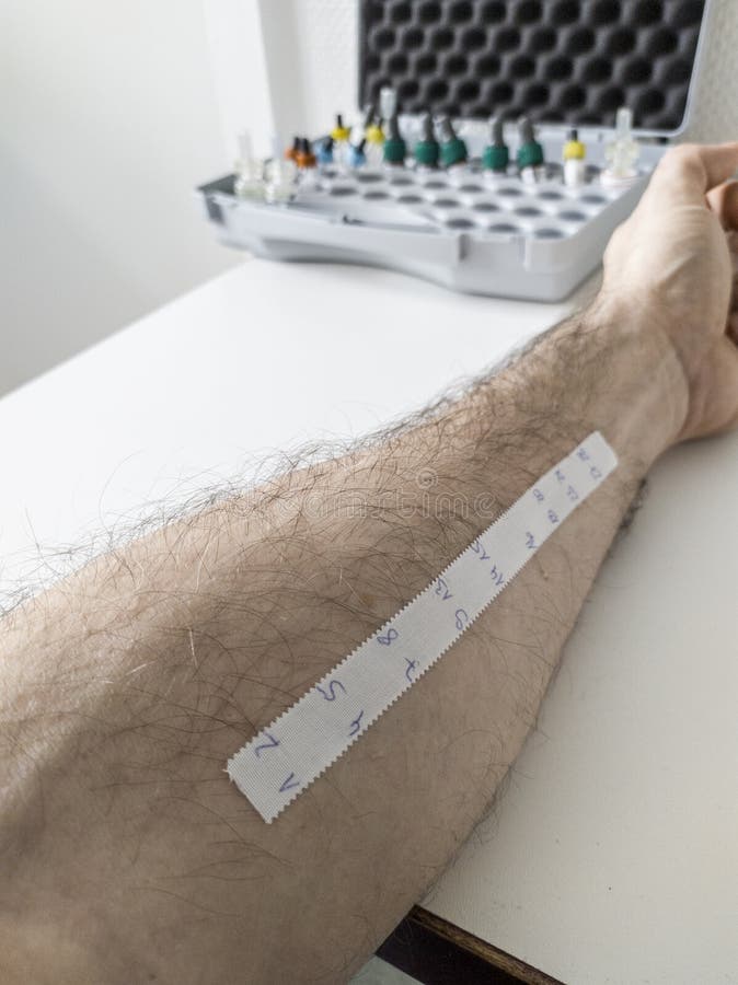 Allergy Scratch Testing Stock Photos - Free & Royalty-Free Stock Photos ...