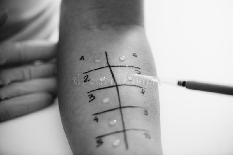 Allergy - Skin Testing stock photo. Image of procedure - 270628660