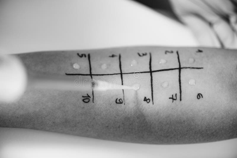 314 Allergy Skin Testing Stock Photos - Free & Royalty-Free Stock ...