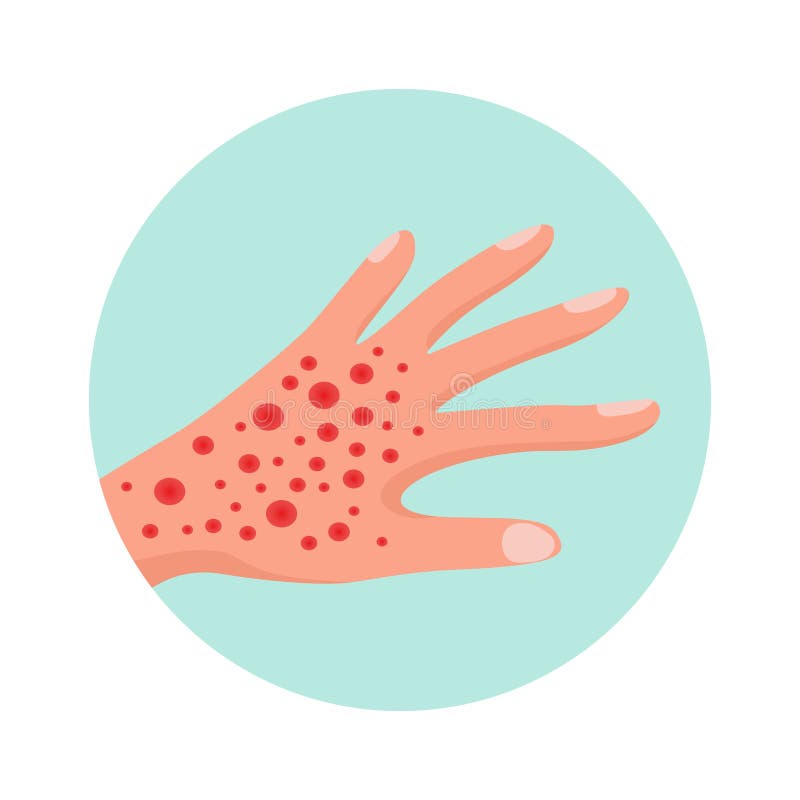 Allergy Symptom Icon stock vector. Illustration of test - 272391732