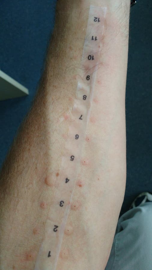 Allergy Test on the Forearm Stock Image - Image of allergy, dermatology ...