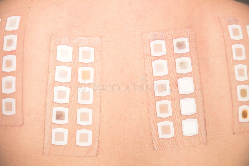 Allergy test stock photo. Image of patch, condition, medicine - 96763060