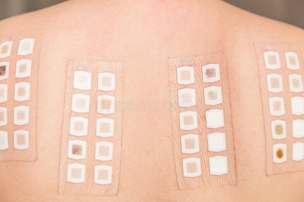 Allergy test stock image. Image of caucasian, skin, allergy - 98495807