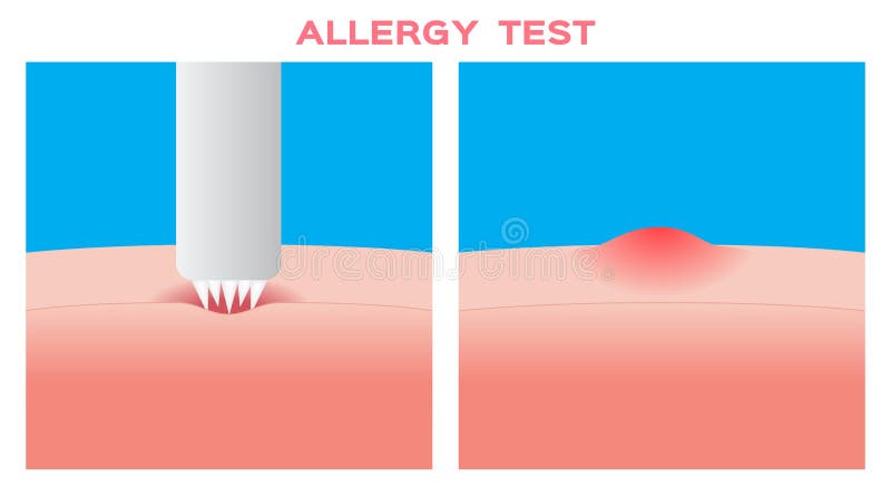Allergy Test Thin Line Icon: Hand and Pipette with Allergens. Modern ...