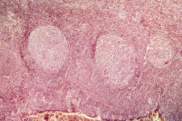 Almond Tonsils in Cross Section Stock Image - Image of tonsillitis ...