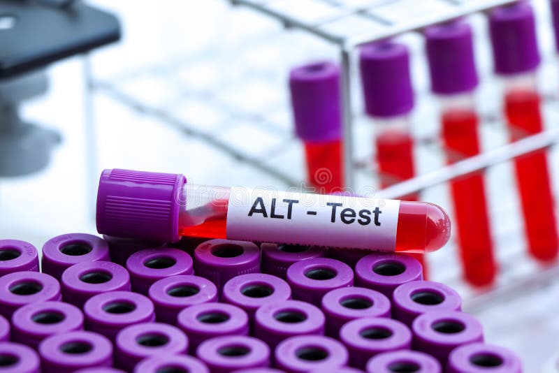 ALT Test To Look for Abnormalities from Blood Stock Image - Image of ...