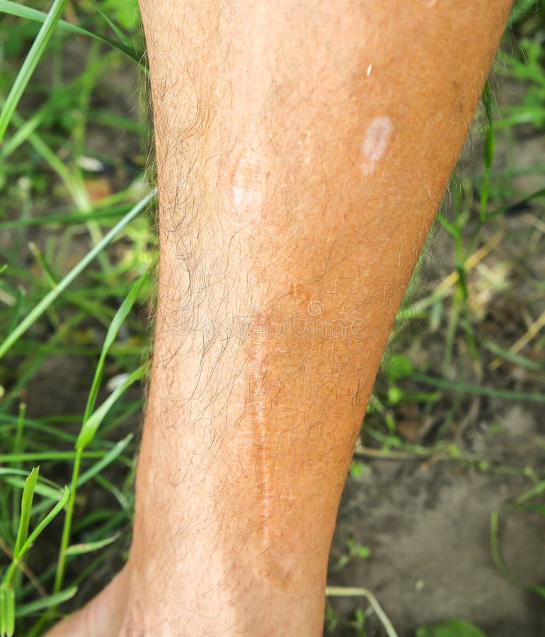 Alte Narbe Personal an Bein. Unfall in Der Vergangenheit Stockfoto ...