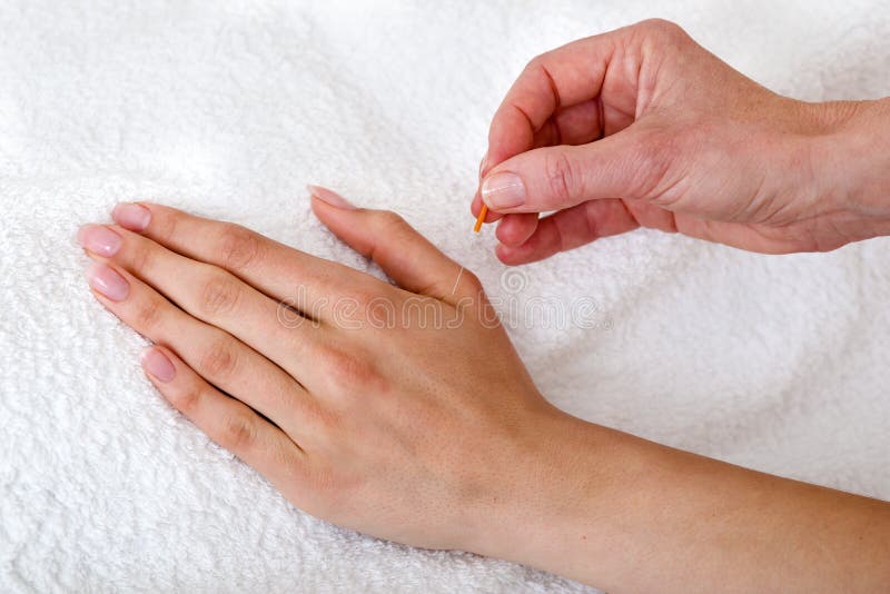 Alternative Practitioner Applying Acupuncture Needles. Stock Photo ...