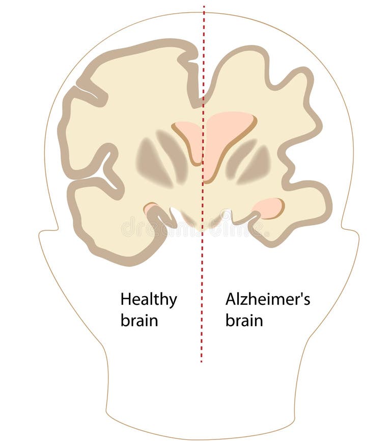 Alzheimer Disease Diagram Stock Illustrations – 303 Alzheimer Disease ...