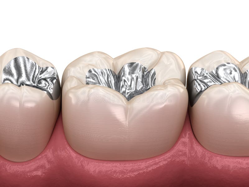 Amalgam Restoration. Medically Accurate 3D Animation of Dental Concept ...
