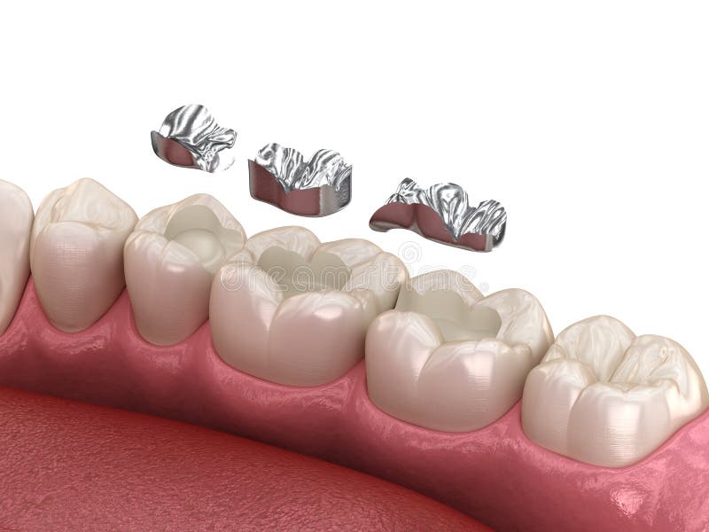 Amalgam Restoration. Medically Accurate 3D Animation of Dental Concept ...