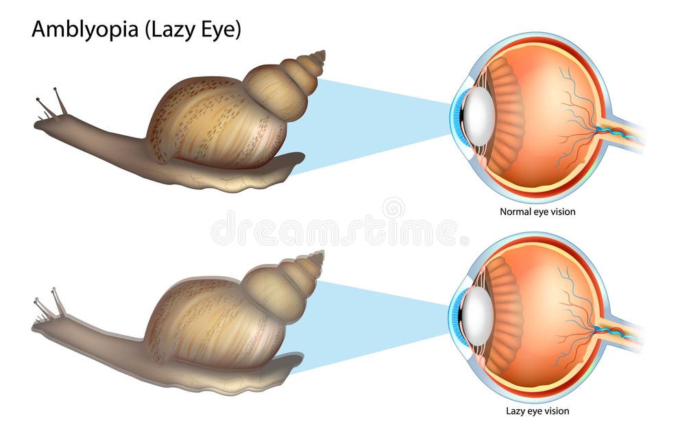 Amblyopia or Lazy Eye. Lazy Eye Vision and Normal Eye Stock Vector ...