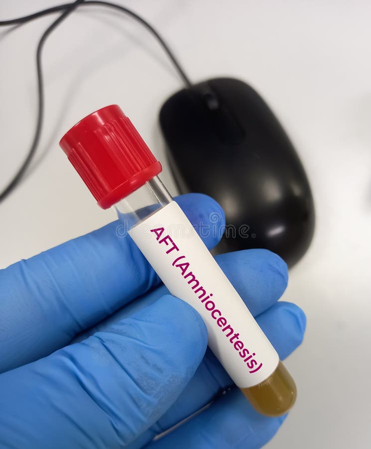 Amniocentesis (amniotic Fluid Test). a Test Done during Pregnancy (15 ...