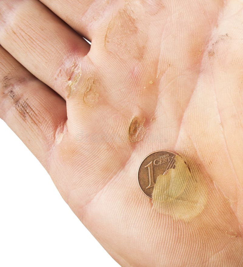 Palmas Con Callos. Ampollas En Las Manos Heridas Por El Trabajo Manual ...