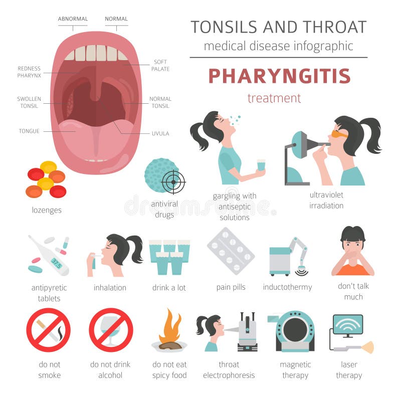 Amígdalas Y Enfermedades De La Garganta Síntomas De La Tonsilitis ... Amígdalas Y Enfermedades De La Garganta Síntomas De La Tonsilitis ...