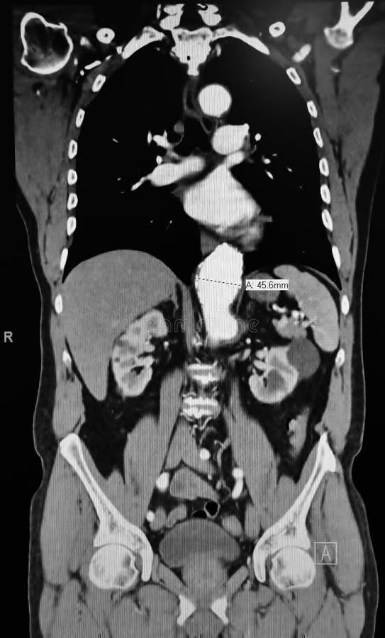 Anévrisme D'aorte Thoracique De Tomographie De Balayage Image stock ...