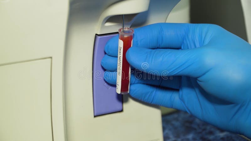 Analysis of Blood Samples in the Laboratory Stock Image - Image of ...
