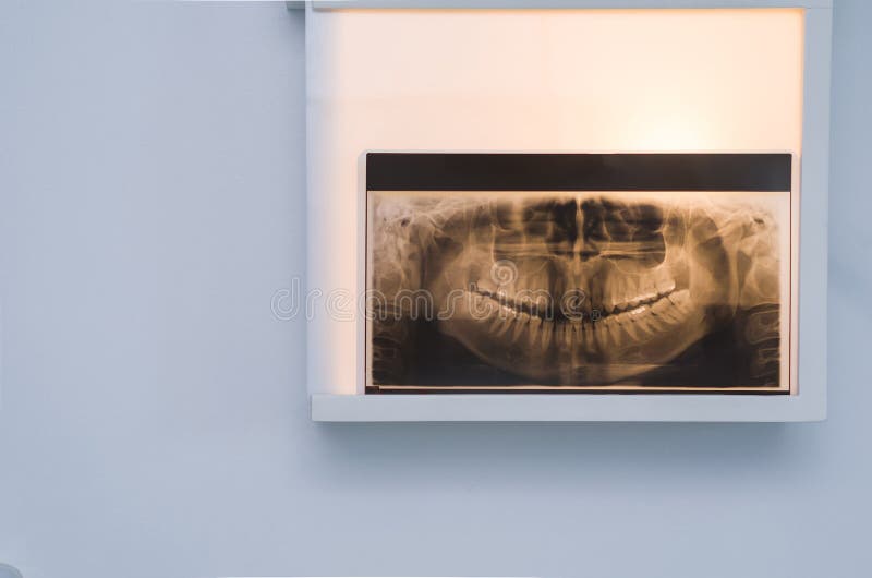 Analyzing Dental X-ray, Tooth X-ray in Viewer on the Wall Stock Photo ...