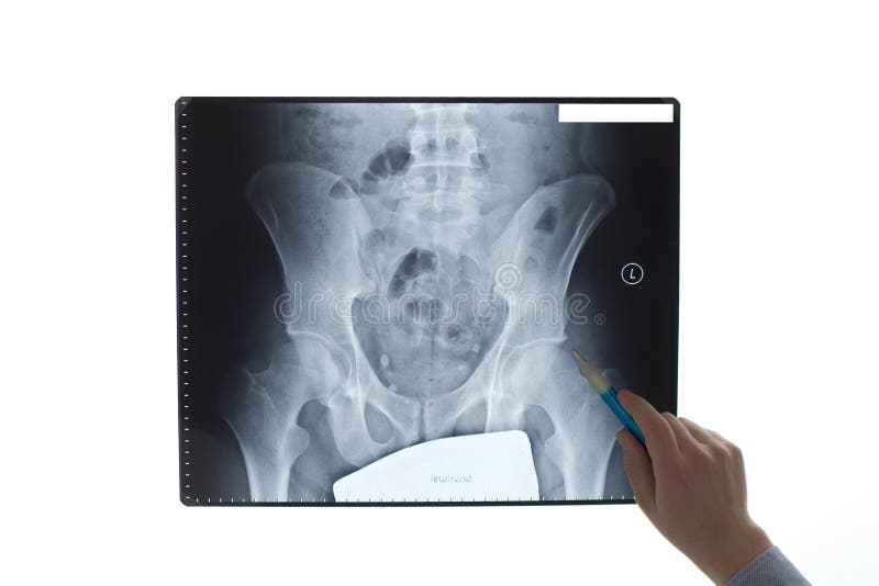 Analyzing x-ray image stock image. Image of disease, osteoporosis ...
