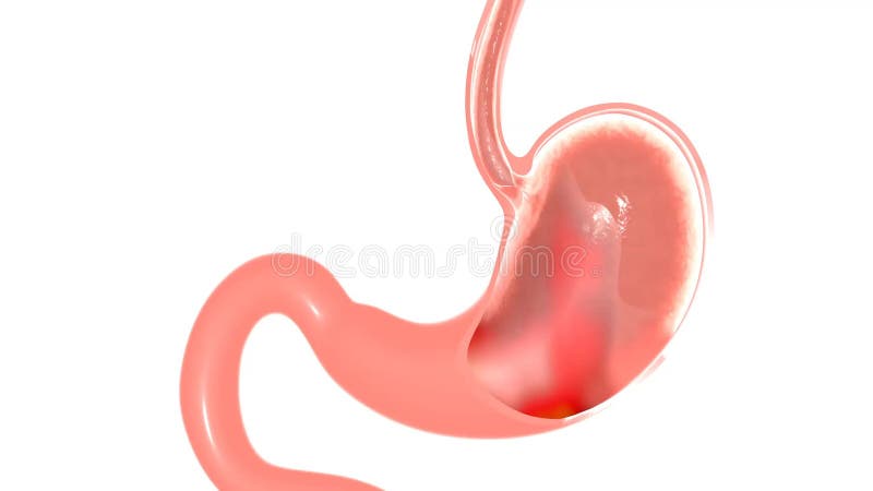 Anatomical 3D Animation of Heartburn. Graphical Representation . Stock ...