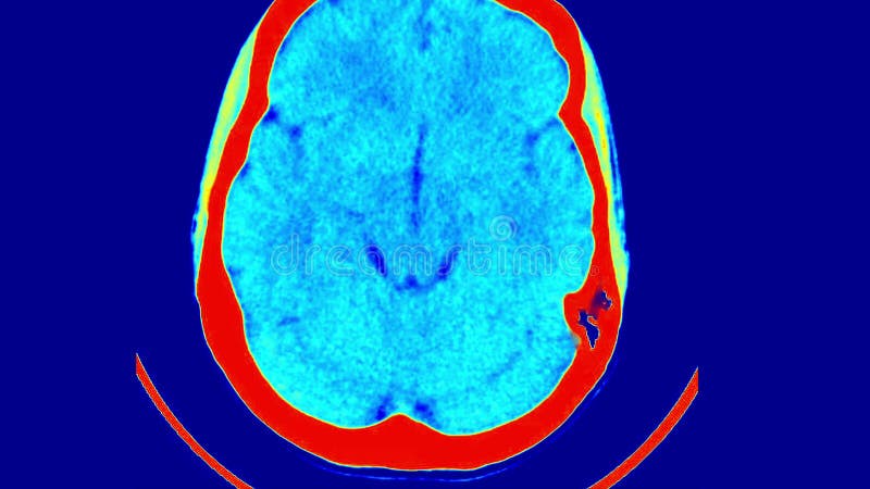 Anatomical MRI Analysis of the Human Brain: Visualizing Cerebral ...